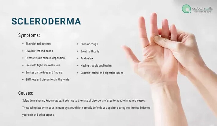 Scleroderma Symptoms, Types, and Available Treatment - Social Social ...